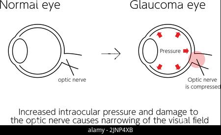 Illustration of how glaucoma works, normal and glaucomatous eyes ...
