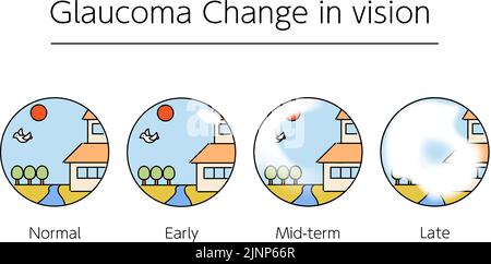 Illustration of glaucoma, changes in visual field as glaucoma ...
