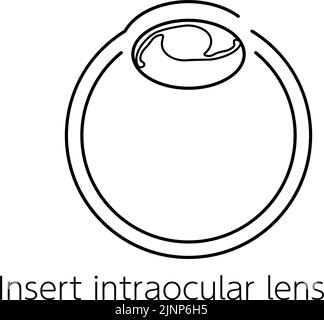 Cataract Surgery Flow, Illustration (Line Drawing), Inserting an ...