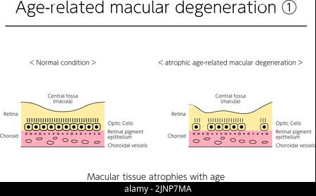 Eye Disease, Atrophic Age-Related Macular Degeneration Illustrated ...