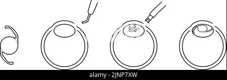 Flow of cataract surgery, illustrated illustration (line drawing ...