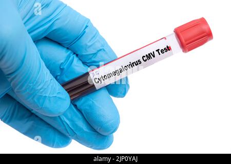 Cytomegalovirus (CMV) Test tube with blood sample in infection lab ...