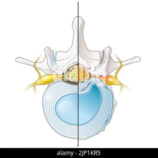 Illustration showing spinal canal stenosis lumbar vertebra with ...