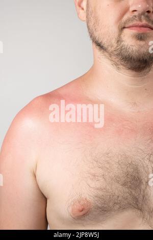 Skin of a person with sunburn, redness of the skin, close-up, space for ...