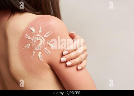 Sunburn on female shoulder, skin care and protection concept Stock ...