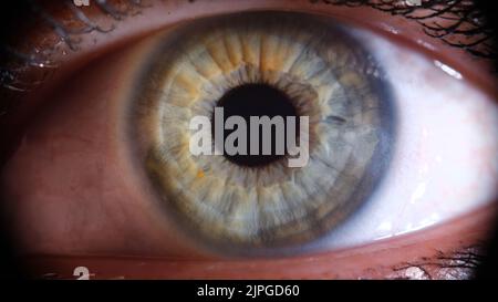 red inflamed eye with contact lens, close-up macrophoto. Dilation of ...