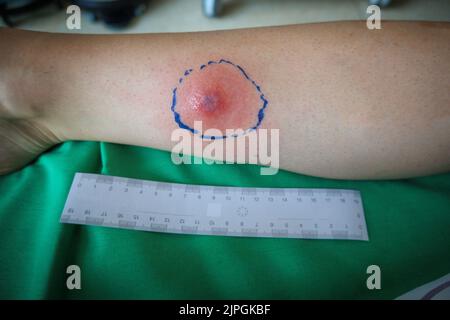 a tick bite has caused abscess on a forearm, a ruler is lying next to ...