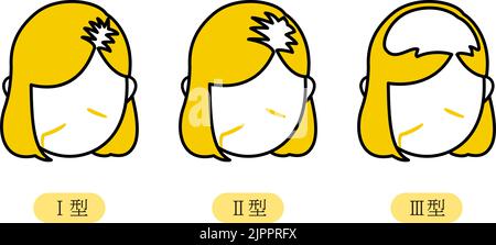 Female Androgenetic Alopecia vector illustration Stock Vector Image ...