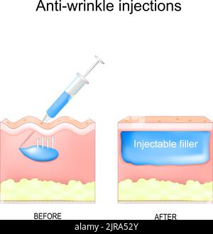 Beauty injection, aesthetic surgery and cosmetology vector illustration ...