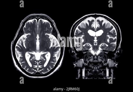 MRI brain Axial T2 technique for detect a variety of conditions of the ...