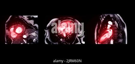 Collection of MRI heart or Cardiac MRI ( magnetic resonance imaging ...