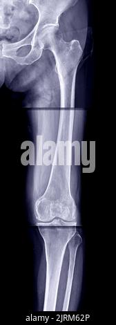 Film x-ray of Hip joint , femur bone and knee joint fusion from 3 image ...
