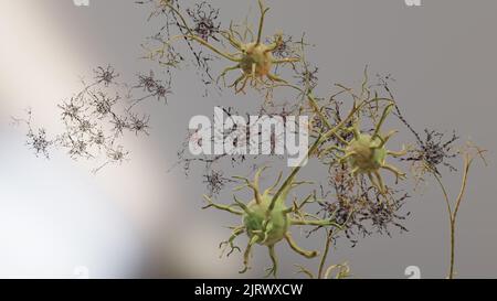 Mild Traumatic Brain Injury, damaged neurons, alzheimers disease ...