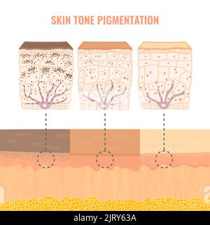 Skin pigmentation, illustration Stock Photo - Alamy