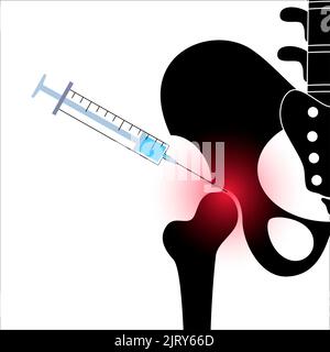 Hip joint injection, illustration Stock Photo - Alamy