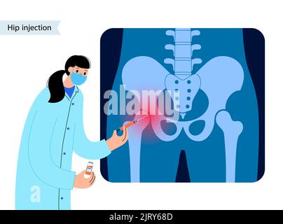 Hip joint injection, illustration Stock Photo - Alamy