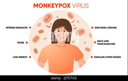 Monkeypox virus symptoms simple infographic. Poster for social media ...