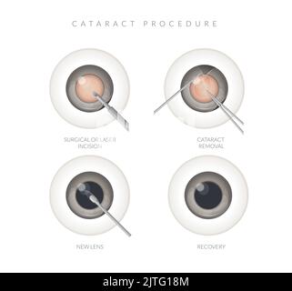 Human Eye - Cataract Procedure - Illustration as EPS 10 File Stock ...