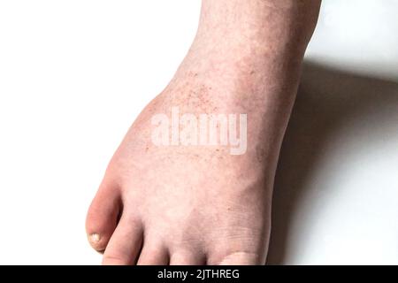 Skin with allergy, food allergy, dermatitis, insect bites, irritation ...