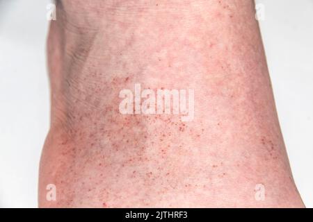 A red rash on the foot of a male against background. CloseUp a part of ...