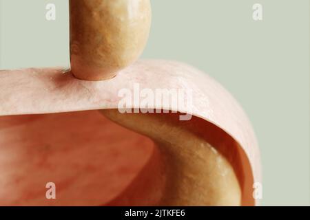 Axial hiatus hernia type 1 - entrance to the stomach via the diaphragm ...