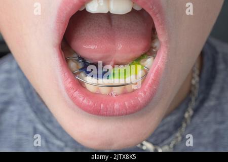 The boy wears a dental plate on the lower jaw, aligning children's ...