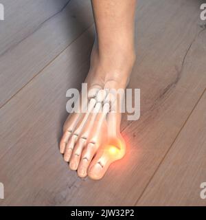 Hallux valgus, illustration. A hallux valgus, or bunion, is an abnormal ...