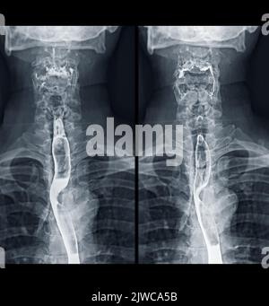 Barium Swallow study test diagnose Barrett's GI tract exam GERD ulcers ...