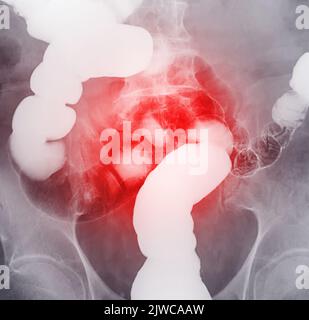 Barium enema or BE is image of large bowel after injection of barium ...