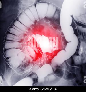 Barium enema or BE is image of large bowel after injection of barium ...