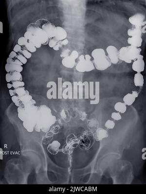 Barium enema or BE is image of large bowel after injection of barium ...