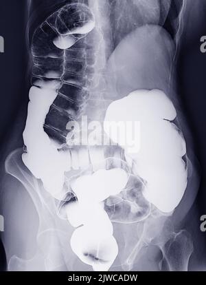 BE or barium enema image or x-ray image of large intestine showing ...