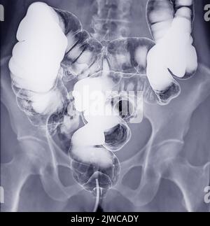 BE or barium enema image or x-ray image of large intestine showing ...