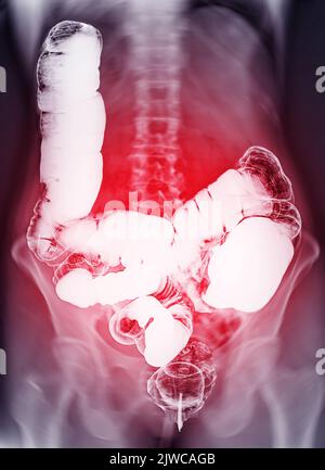 Barium enema or BE is image of large bowel after injection of barium ...