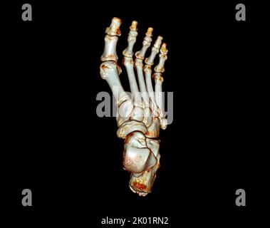 Computed Tomography of the Foot ,3D Volume Rendering examination of the ...