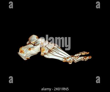 Computed Tomography of the Foot ,3D Volume Rendering examination of the ...