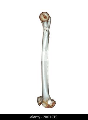 CT scan of Femur bone og thigh bone 3D rendering for diagnosis fracture ...