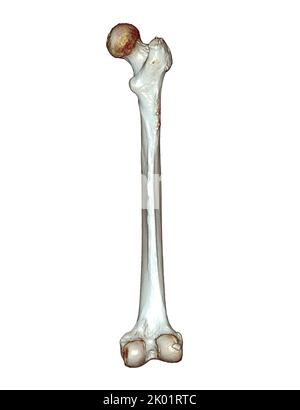 CT scan of Femur bone og thigh bone 3D rendering for diagnosis fracture ...