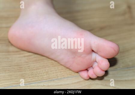 Enterovirus Feet Rash on the body of a child. Cocksackie virus rash ...