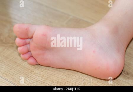 Enterovirus Feet Rash on the body of a child. Cocksackie virus rash ...