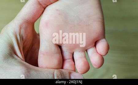 Enterovirus Feet Rash on the body of a child. Cocksackie virus rash ...