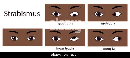 Strabismus flat style infographic set of stages: normal and disorders ...