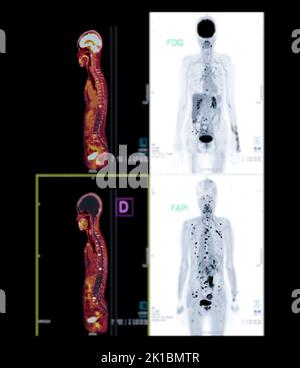 Positron emission tomography (PET) CT scan uses a radioactive drug ...