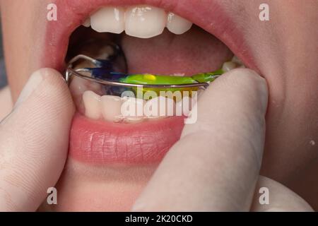 The orthodontist puts a plate on the lower teeth, a visit to the ...