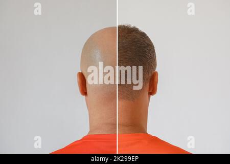 male baldness before and after treatment. portrait of a man with ...