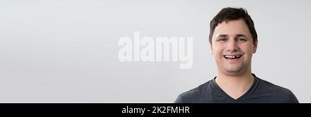 Smile With Missing Tooth. Broken Tooth Absence Stock Photo - Alamy