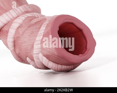 Bronchitis anatomy concept as an inflammation of bronchial tube lining ...