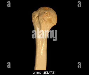 CT scan of head of humerus 3D of Computed Tomography Volume Rendering ...