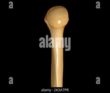 CT scan of head of humerus 3D of Computed Tomography Volume Rendering ...