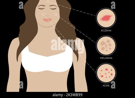 Illustration of Eczema, Acne and Melasma with Woman Background Stock ...